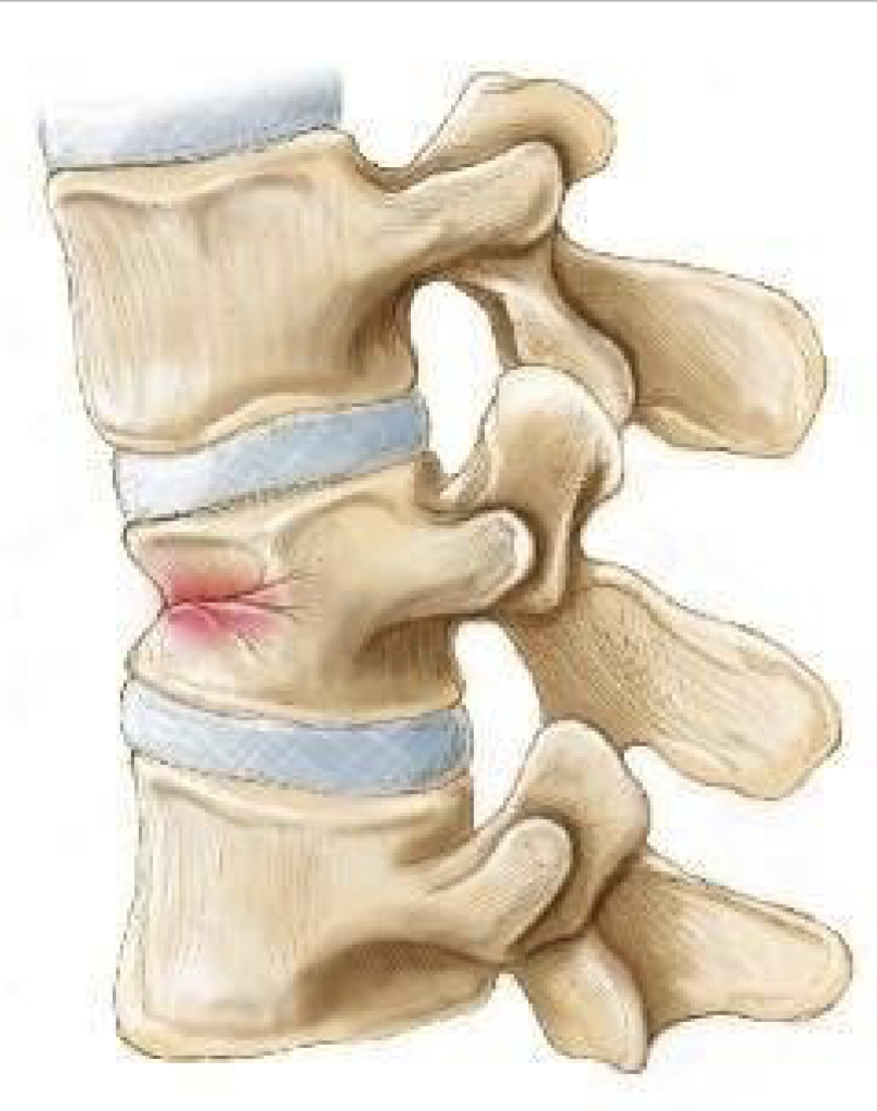 Osteoporotic Spine Fracture - Best Spine Surgeon In Mumbai