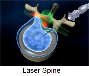 Laser Spine Surgery - Best Spine Surgeon In Mumbai